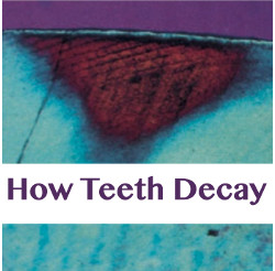 How Teeth Decay - The interplay between sugar, pH, saliva and plaque